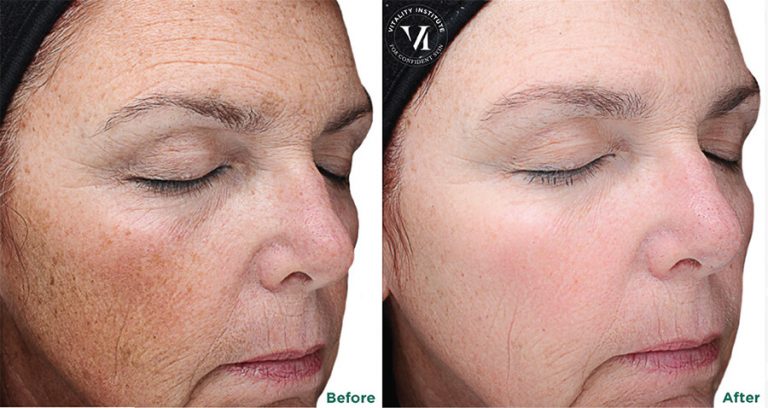 VI Peels - Vein & Laser Institute
