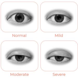 Upneeq Eye Opening Drops - Vein & Laser Institute